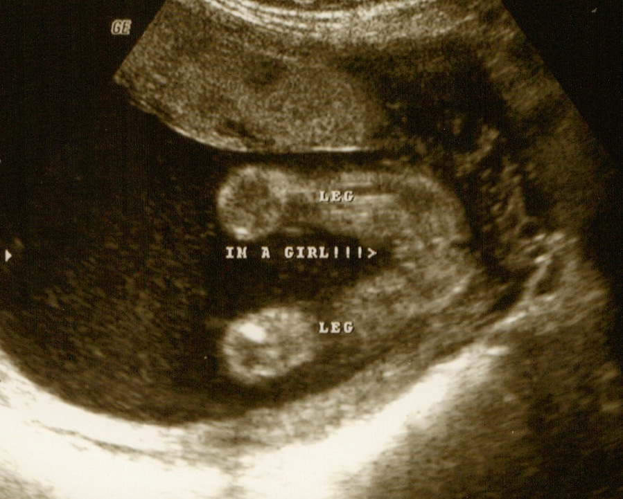 20 Weeks Ultrasound Girl